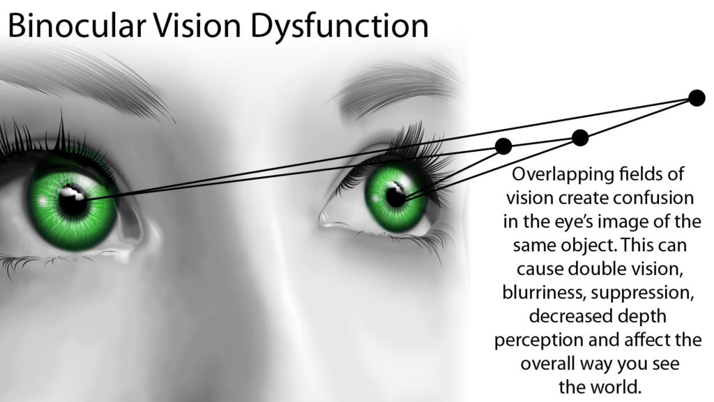 Binocular Vision Problems Precision Family Eyecare