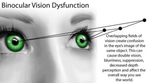 Binocular Vision Problems – Precision Family Eyecare