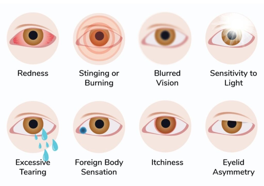 Dry Eye Syndrome Precision Family Eyecare Dry Eye Syndrome Precision Family Eyecare