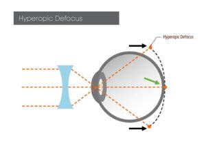 Myopia Management Program – Precision Family Eyecare